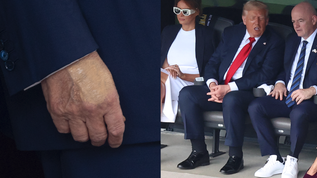 Trump’s Leg Swelling Linked to Chronic Venous Insufficiency Diagnosis ...